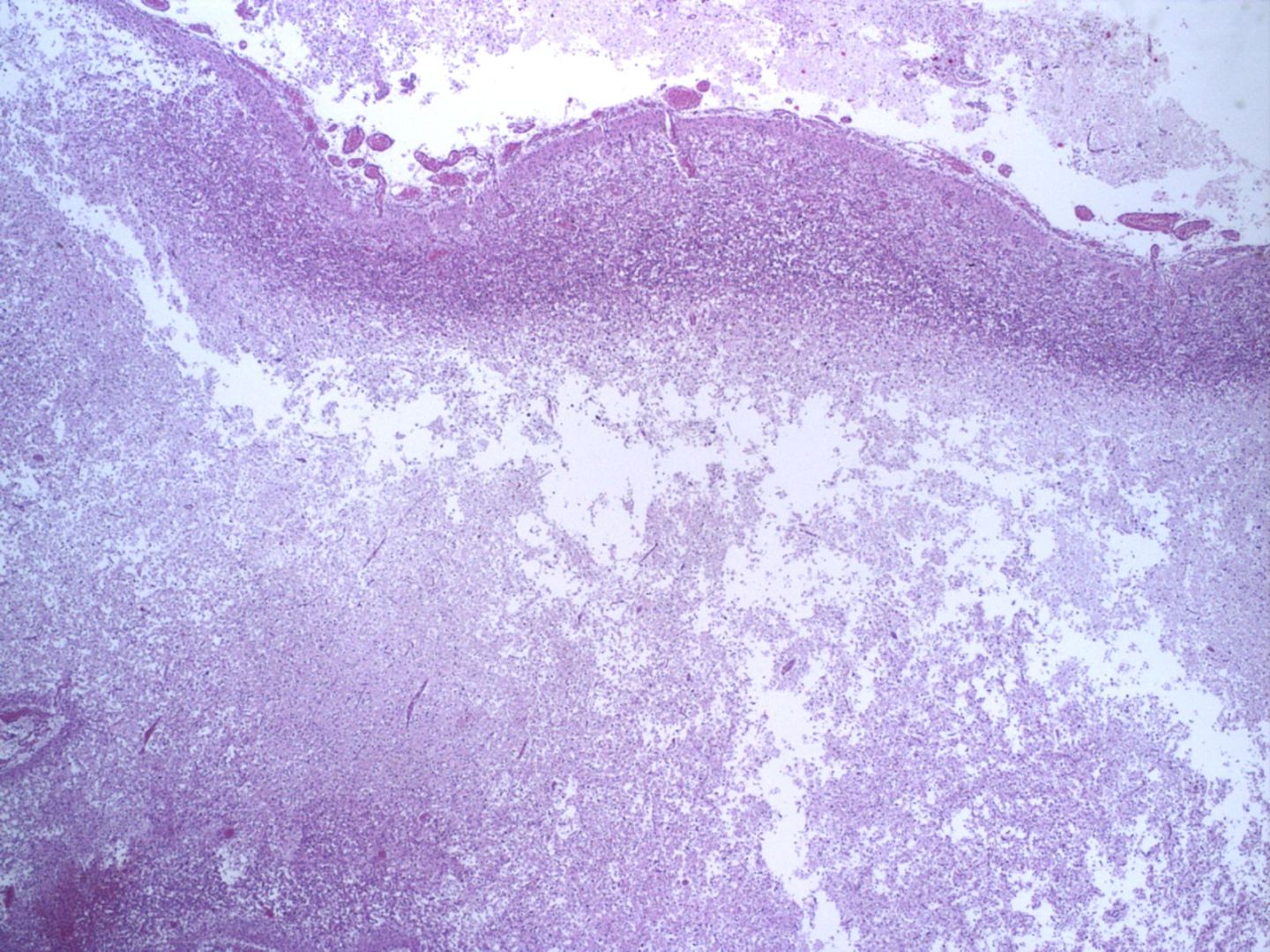 Autopsy Manual: Brain | obstetrical pathology