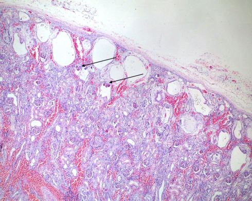 Kidney: Autopsy Manual | obstetrical pathology