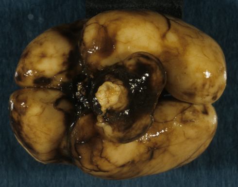 Fetal Autopsy: Brain | The Autopsy Book