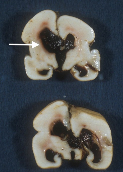 Fetal Autopsy: Brain | The Autopsy Book