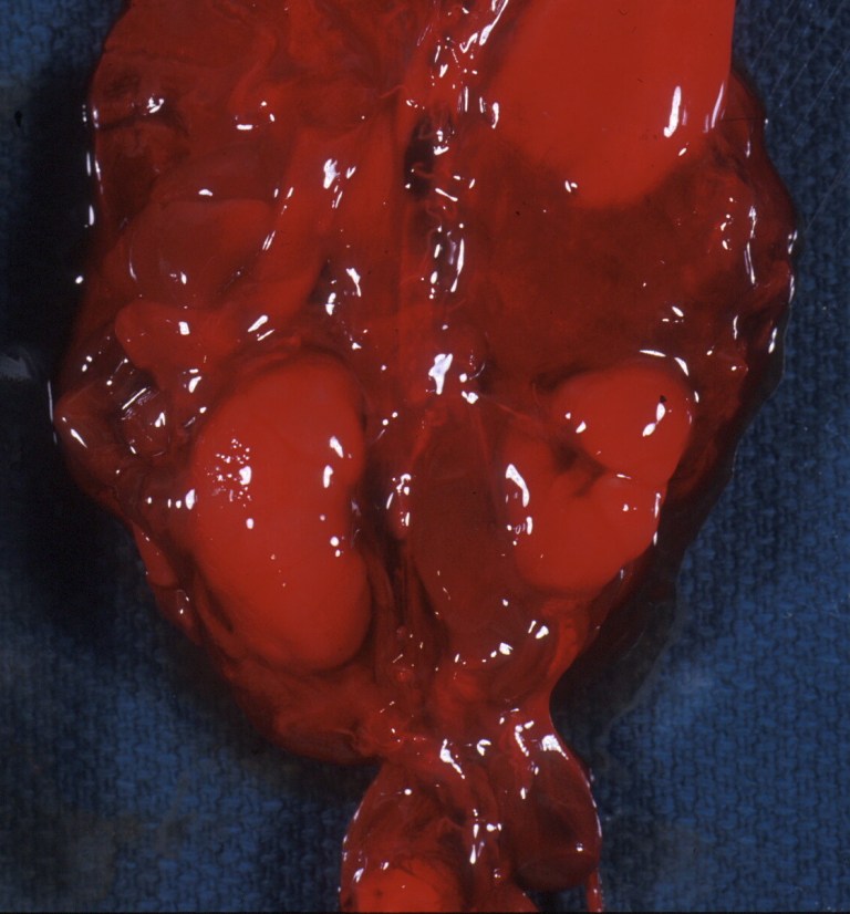 Fetal Autopsy: Kidney | The Autopsy Book