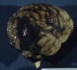Fetal Autopsy: Brain | The Autopsy Book