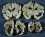 Fetal Autopsy: Brain | The Autopsy Book