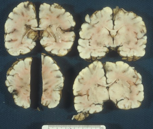 Fetal Autopsy: Brain | The Autopsy Book