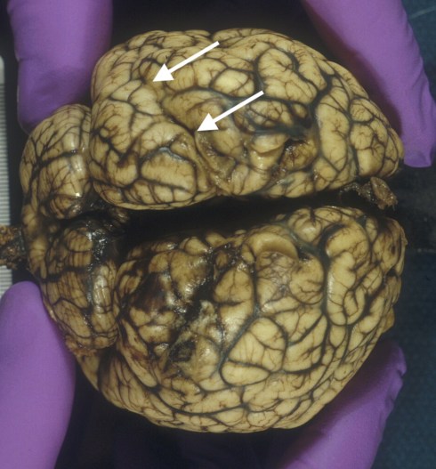 Fetal Autopsy: Brain | The Autopsy Book