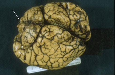 Autopsy Manual: Brain | obstetrical pathology