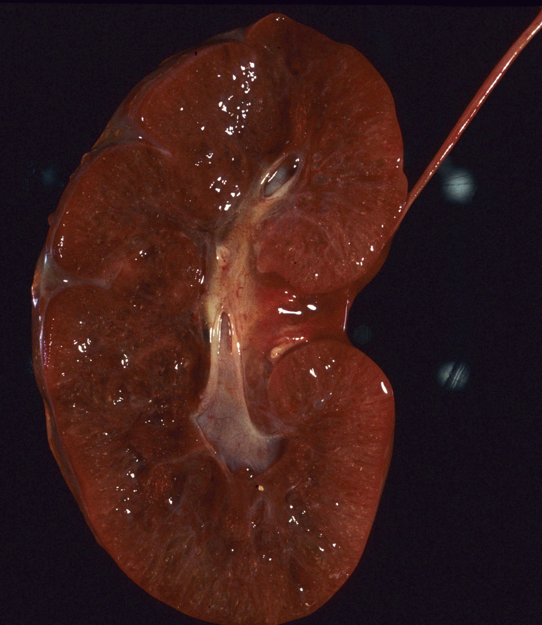 Kidney: Autopsy Manual | obstetrical pathology