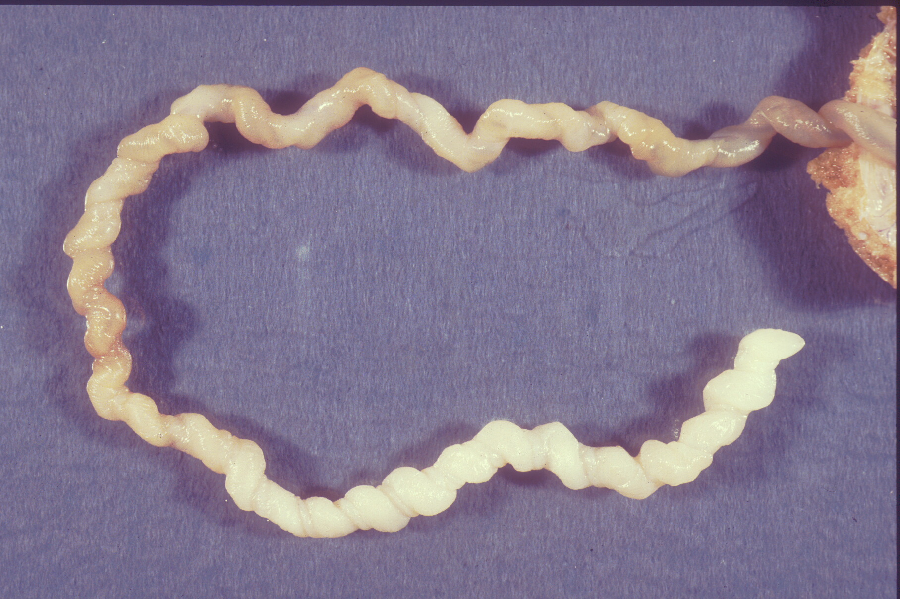 Umbilical cord coiling index. | obstetrical pathology