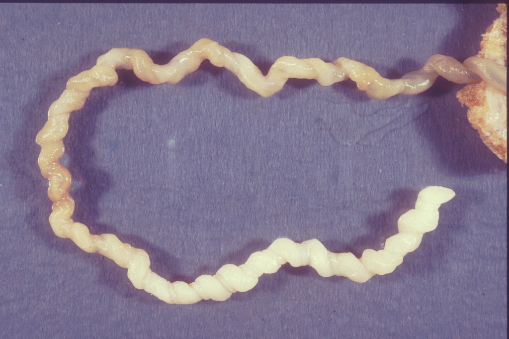 Umbilical cord coiling index. | obstetrical pathology