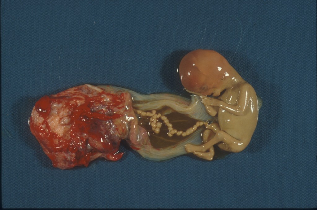 Umbilical cord coiling index. | obstetrical pathology