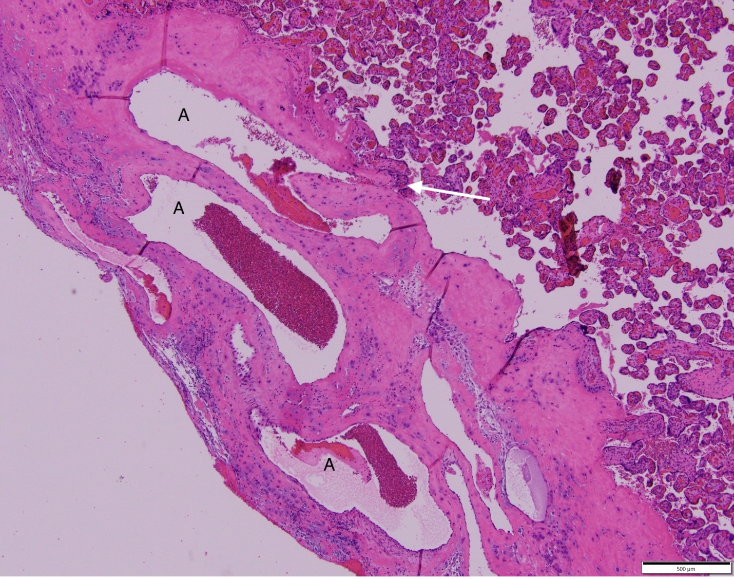 Letters On Obstetrical Pathology #2 | obstetrical pathology